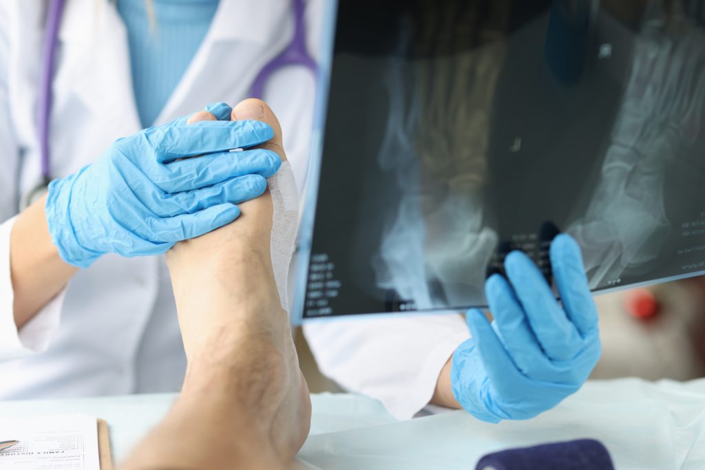 A Guide for Cartiva Toe Implant Injuries | ToeImplantFailure