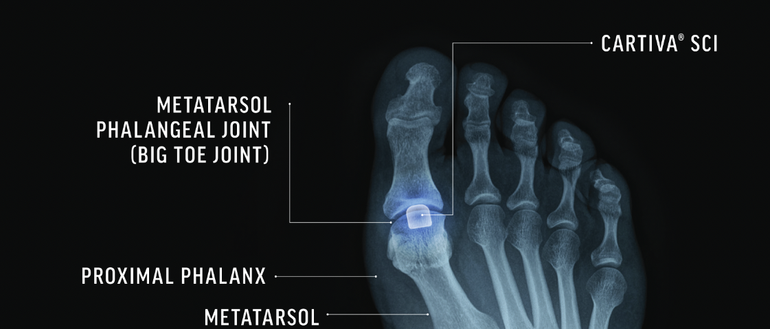 Analysis of Cartiva Implant