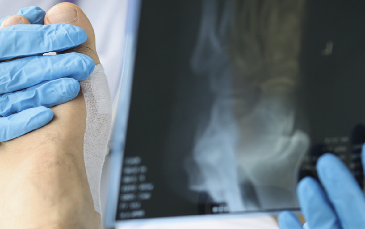 Complications of the Cartiva Implant
